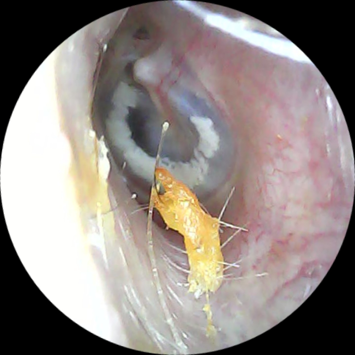 Timpanoesclerosis: una condición auditiva común pero tratable – Mi ...